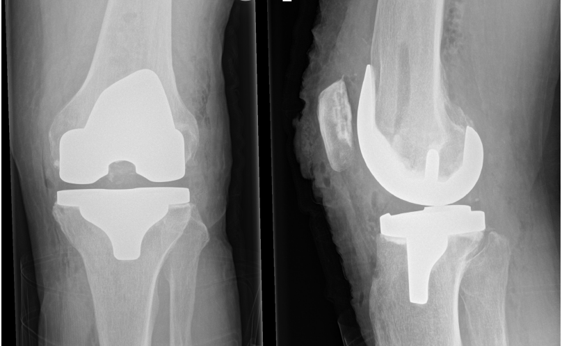 Mr. Nayef Aslam-Pervez | Consultant Orthopaedic Surgeon | Bespoke ...